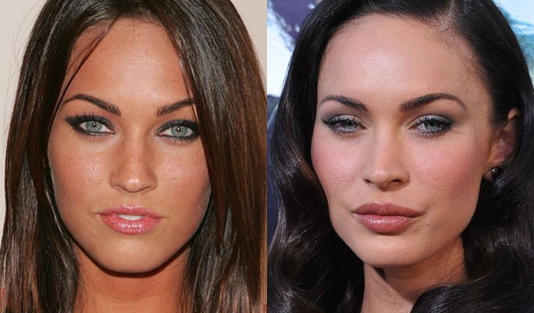 These Celebrities Have Undergone Transformative Rhinoplasty Surgery ...