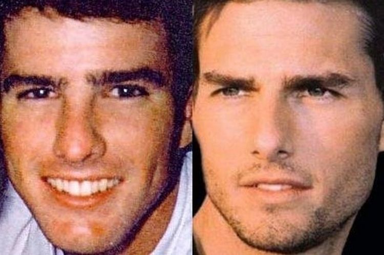These Celebrities Have Undergone Transformative Rhinoplasty Surgery